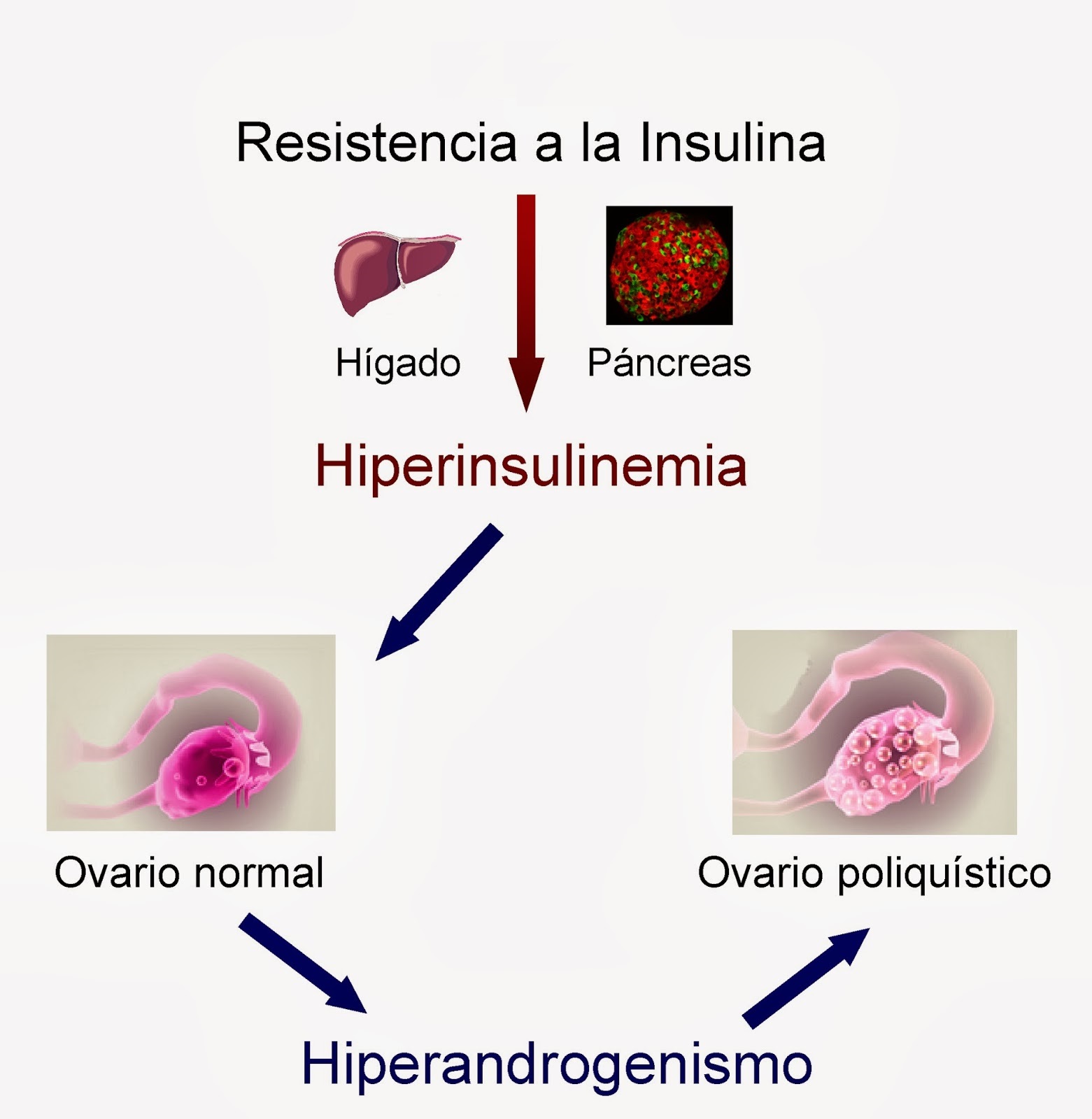 ¿Qué es el Síndrome de Ovarios Poliquísticos (SOP)? Todo sobre su ...